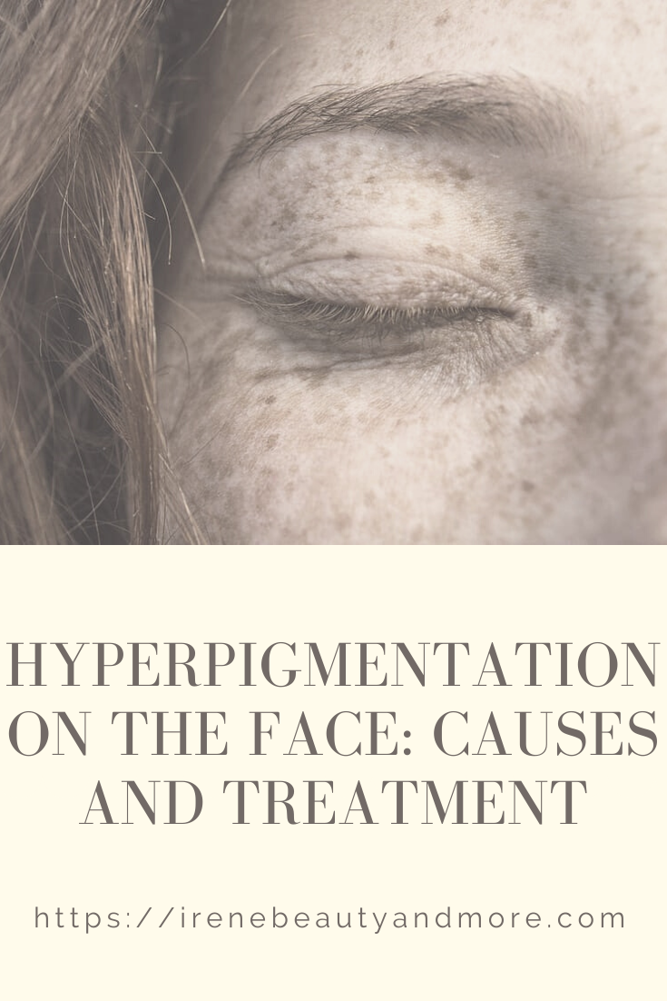 Hyperpigmentation on the Face: causes and treatment